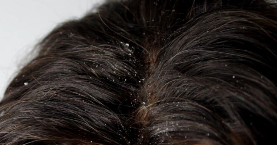 Coisas que podem estar causando caspa - Dra. Luciana Pepino